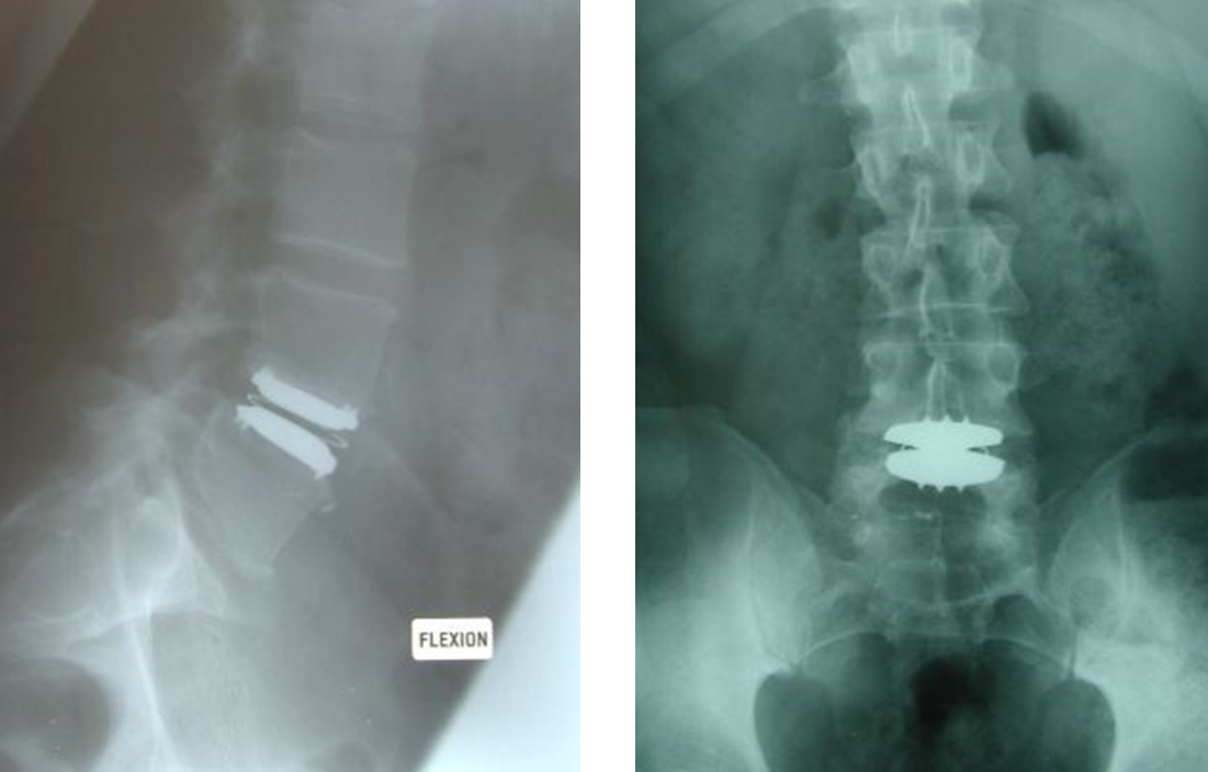 Artificial Lumbar Disc Surgery - Reno Orthopedic Center