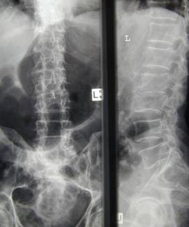 Artificial Lumbar Disc Surgery - Reno Orthopedic Center