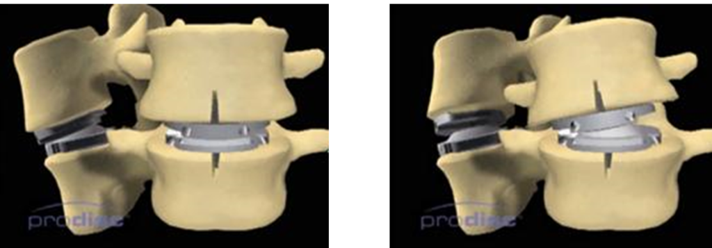 Artificial Lumbar Disc Surgery - Reno Orthopedic Center