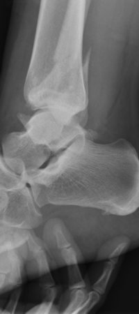 Broken Ankle | Reno Orthopedic Center