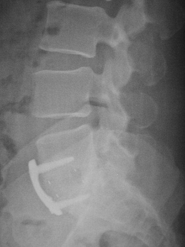 Anterior Lumbar Interbody Fusion (ALIF) Surgery | ROC