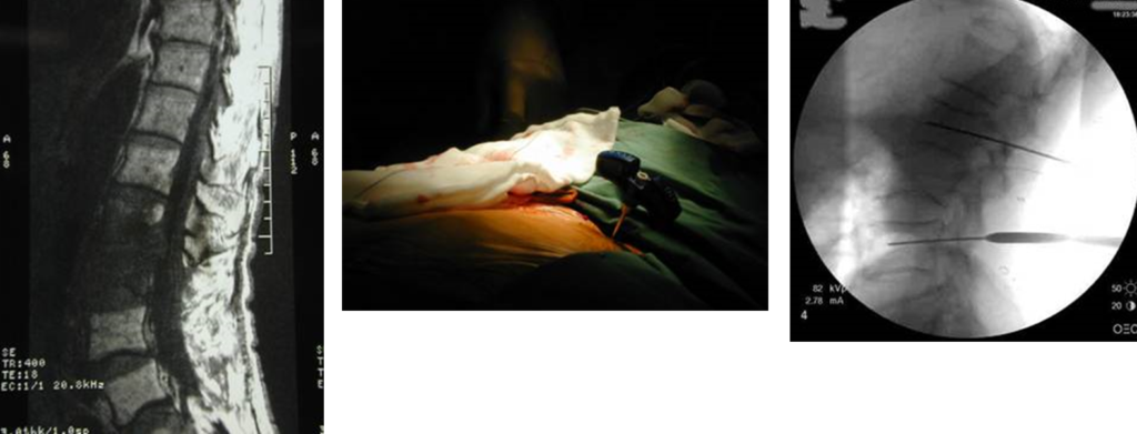 Cervical Artificial Disc Surgery - Reno Orthopedic Center