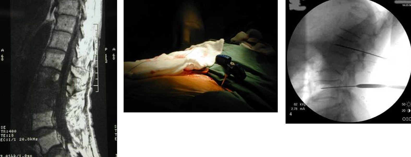 Cervical Artificial Disc Surgery - Reno Orthopedic Center