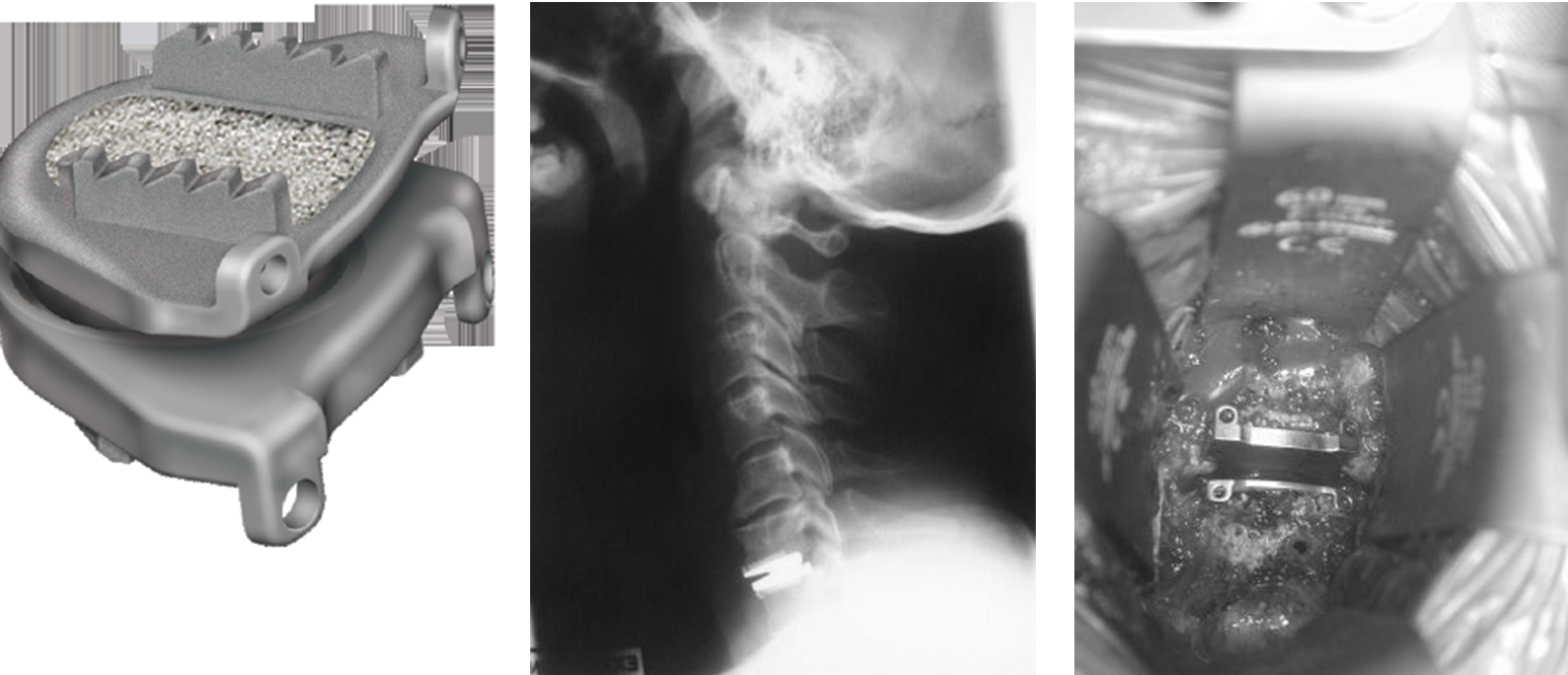Cervical Artificial Disc Surgery - Reno Orthopedic Center