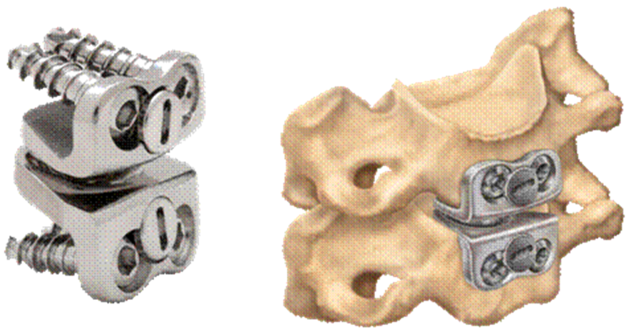 Cervical Artificial Disc Surgery - Reno Orthopedic Center