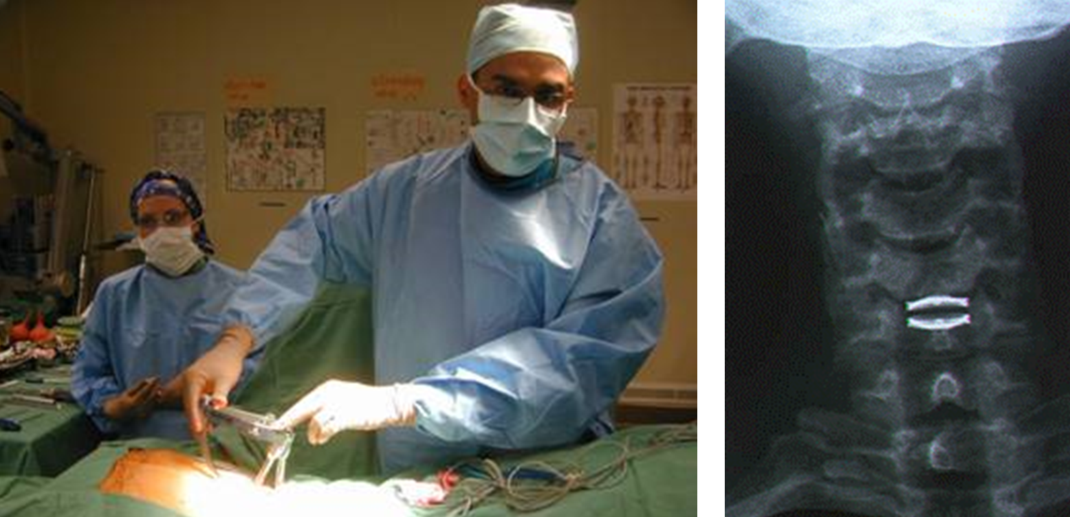 Cervical Artificial Disc Surgery - Reno Orthopedic Center