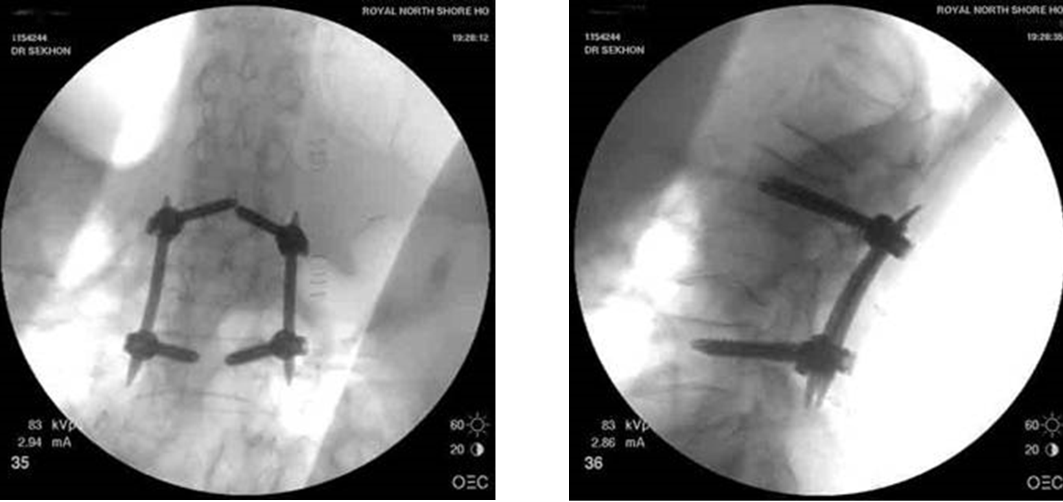 Cervical Artificial Disc Surgery - Reno Orthopedic Center