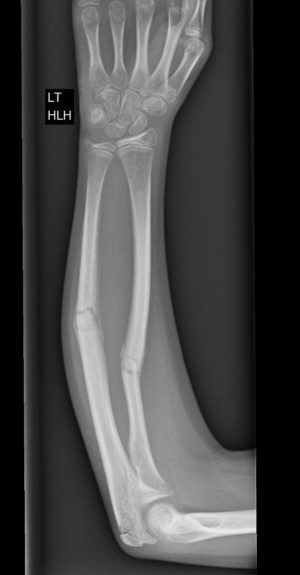 Forearm Fracture - Reno Orthopedic Center