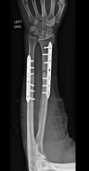 Forearm Fracture - Reno Orthopedic Center