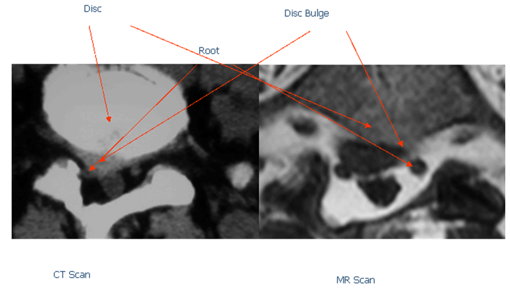 Disc Herniations, Sciatica and Microdiscectomy - Reno Orthopedic Center