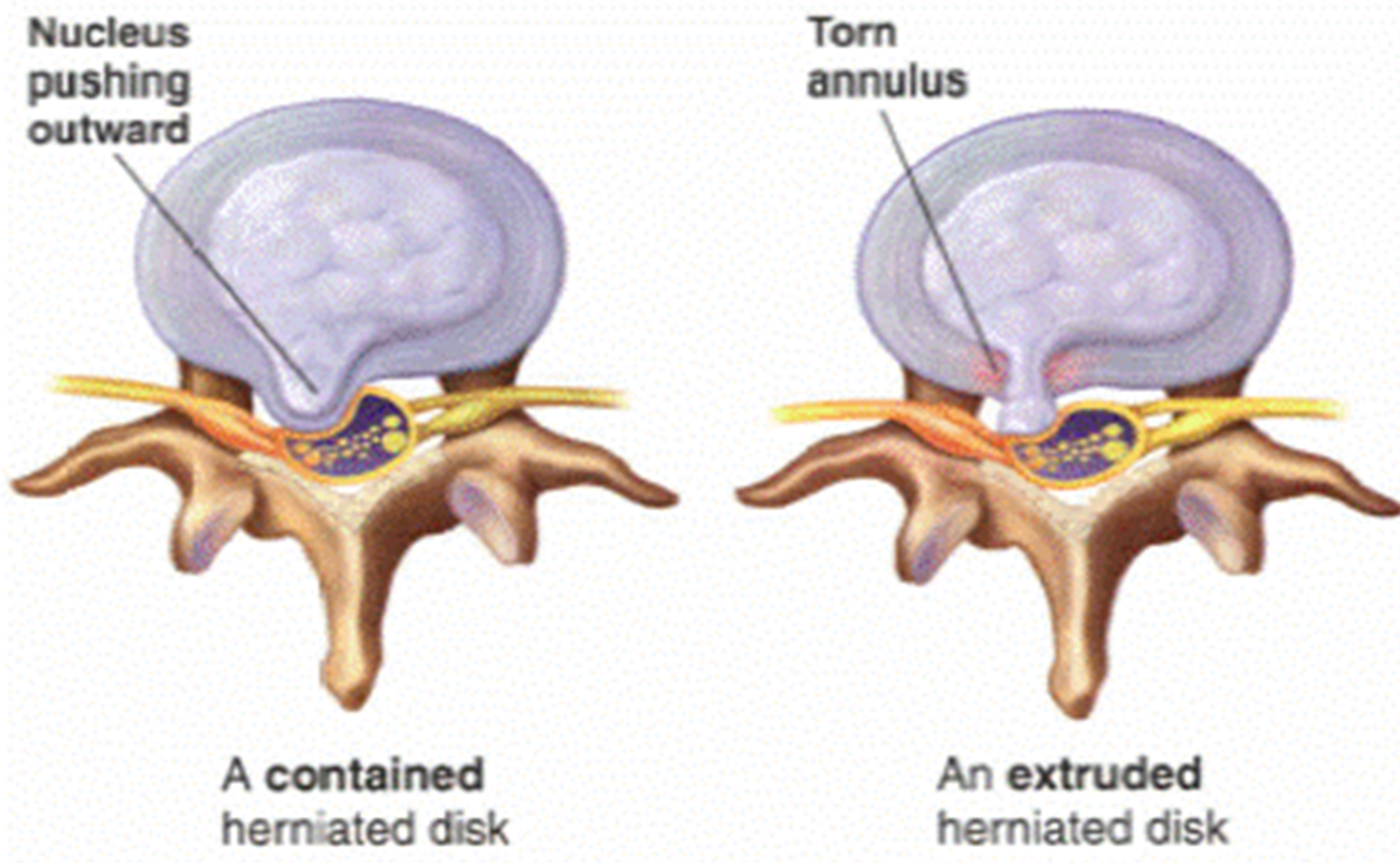 Disc Herniations, Sciatica and Microdiscectomy - Reno Orthopedic Center