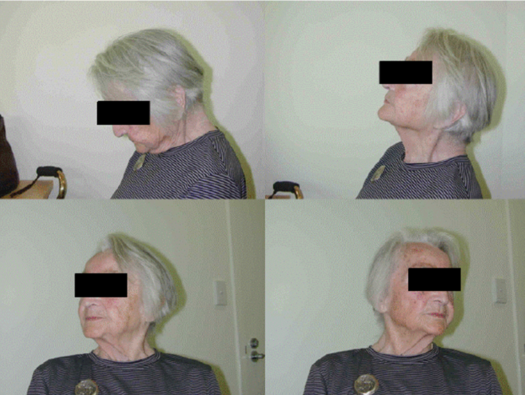 Posterior Cervical Fusion | Reno Orthopedic Center