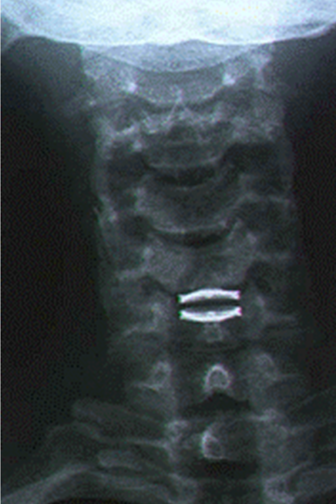 Posterior Cervical Fusion | Reno Orthopedic Center