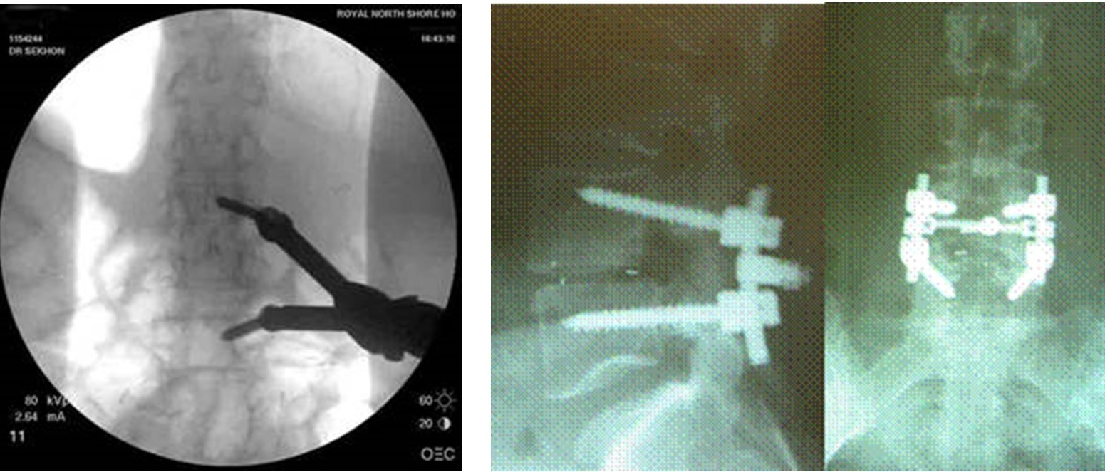Posterior Lumbar Fusion - Reno Orthopedic Center