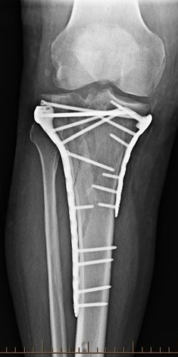 Tibial Plateau Fracture | Diagnosis & Treatments | Reno Orthopedic Center