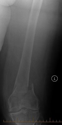 Distal Femur | Diagnosis & Treatments | Reno Orthopedic Center