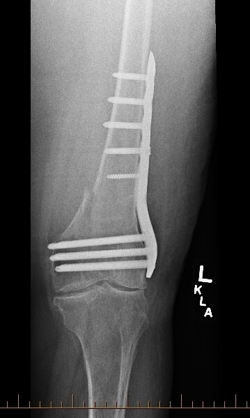 Distal Femur | Diagnosis & Treatments | Reno Orthopedic Center
