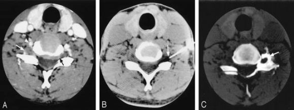 Spinal Injections | Purpose, Types & Procedure | ROC