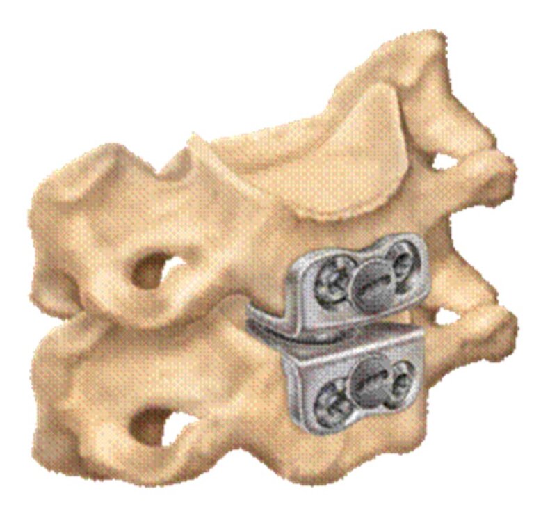 Spinal Injections | Purpose, Types & Procedure | ROC