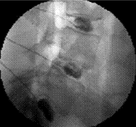 Spinal Injections | Purpose, Types & Procedure | ROC