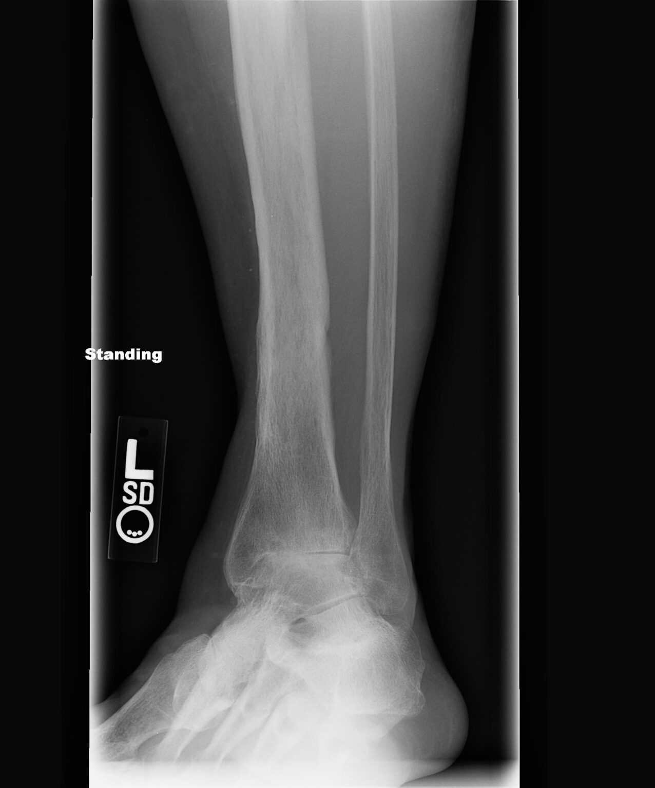 Total Ankle Replacement | Reno, Sparks, Carson | ROC