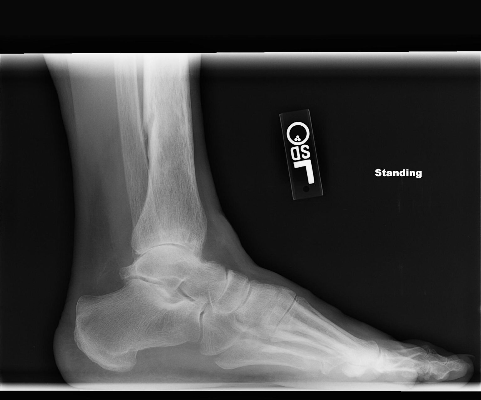 Total Ankle Replacement | Reno, Sparks, Carson | ROC