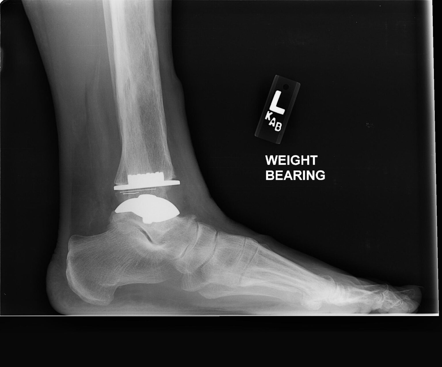 Total Ankle Replacement | Reno, Sparks, Carson | ROC