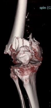 Distal Femur | Diagnosis & Treatments | Reno Orthopedic Center