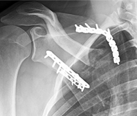 Scapular Fracture (Broken Shoulder Blade) | Reno Orthopedic Center