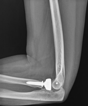 Elbow Dislocations - Reno Orthopedic Center