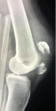 Patella Fracture (Broken Kneecap) | Reno Orthopedic Center