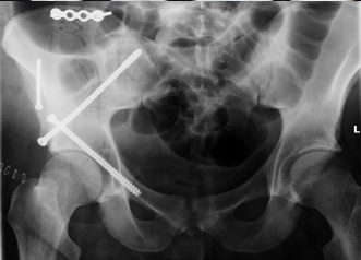 Acetabular (Hip Socket) Fractures - Reno Orthopedic Center